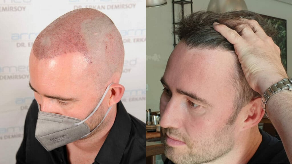 Haartransplantation Türkei Vorher Nachher Ergebnisse überzeugen